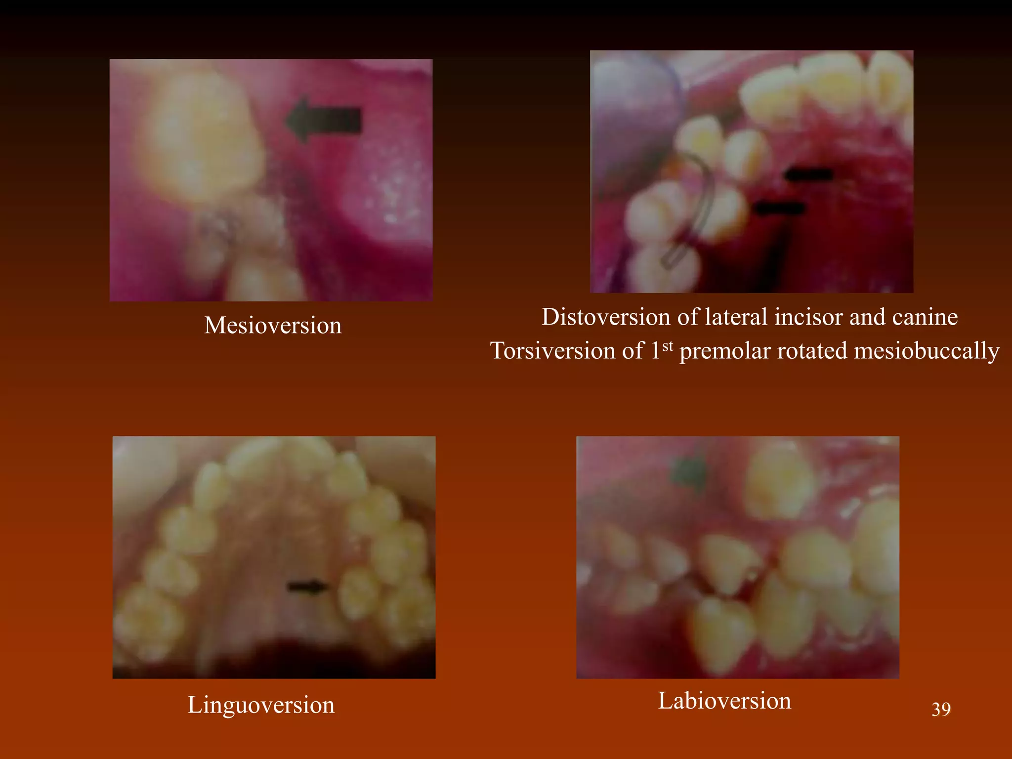 Classification-of-Malocclusion O.ppt