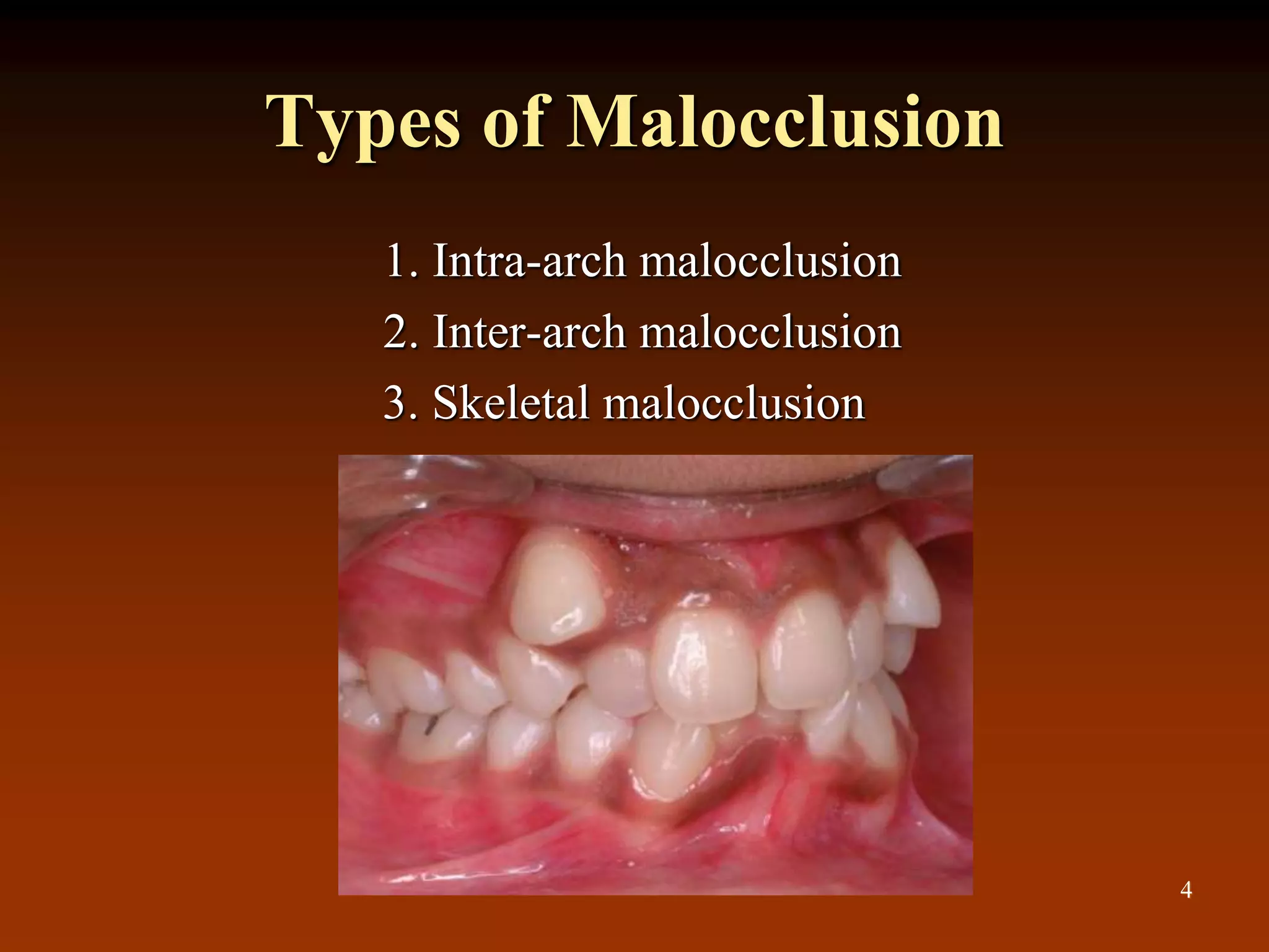 Classification-of-Malocclusion O.ppt