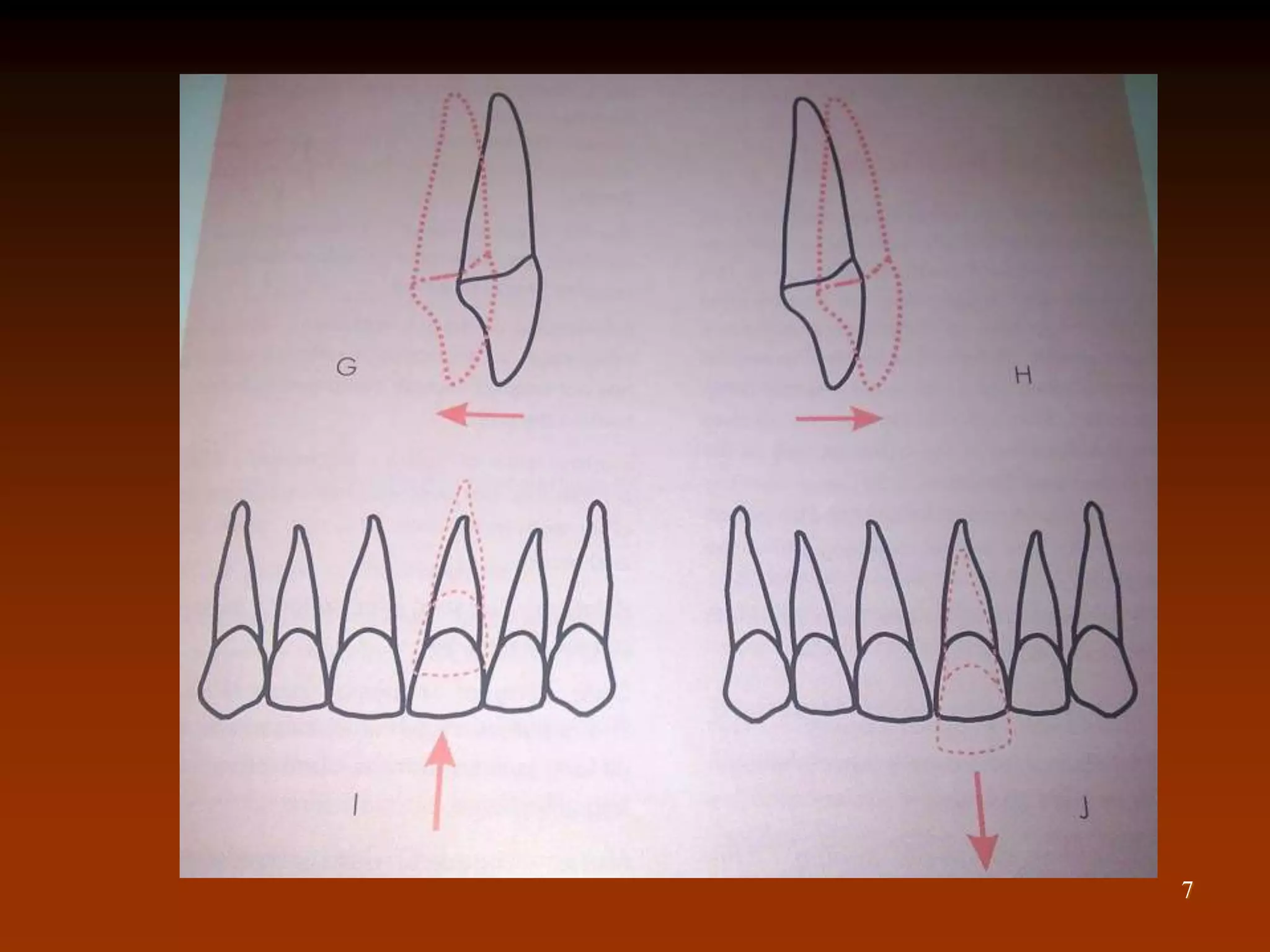 Classification-of-Malocclusion O.ppt