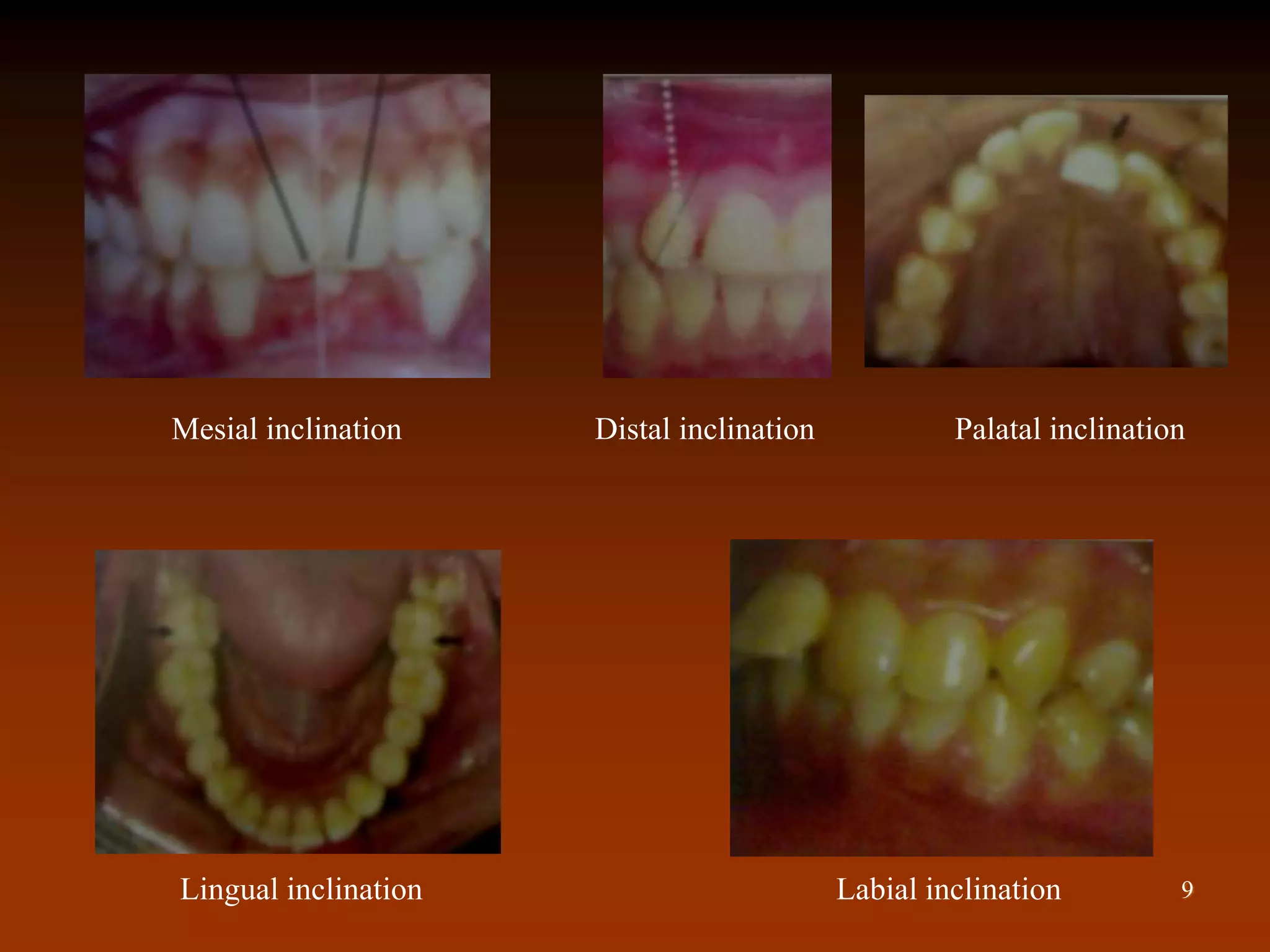 Classification-of-Malocclusion O.ppt