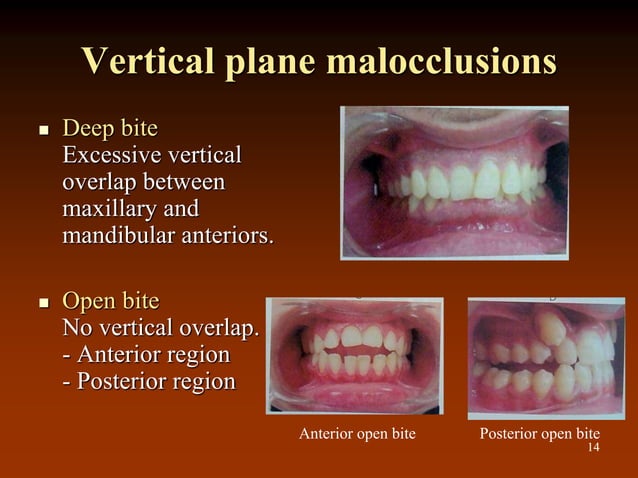 Classification-of-Malocclusion O.ppt