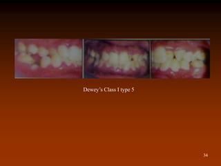 Classification-of-Malocclusion O.ppt