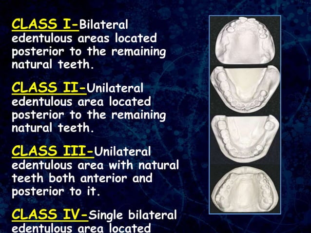 Classification of Partially Edentulous Arches | PPTX