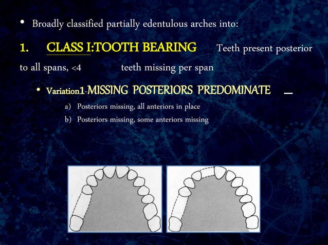 Classification of Partially Edentulous Arches | PPTX