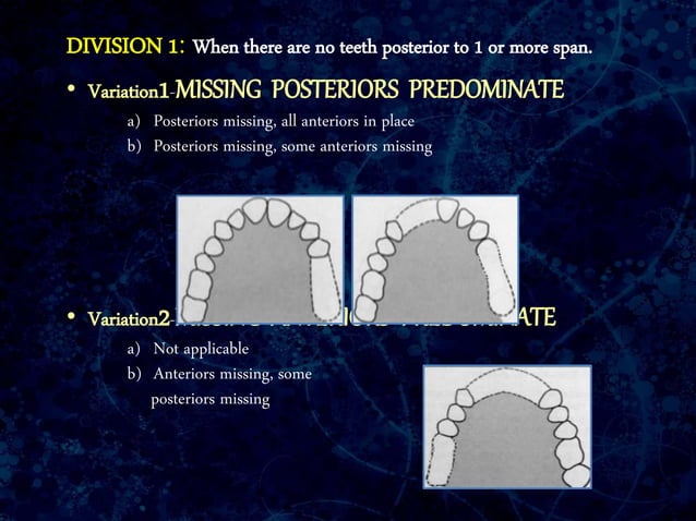 Classification of Partially Edentulous Arches | PPTX
