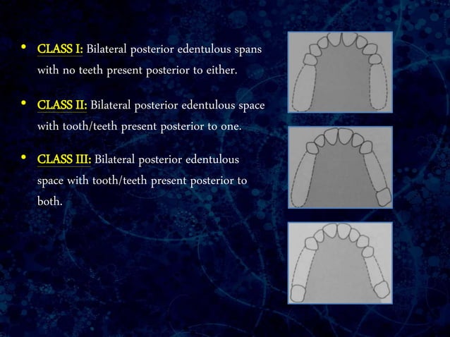 Classification of Partially Edentulous Arches | PPTX