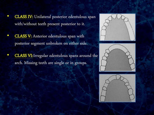 Classification of Partially Edentulous Arches | PPTX