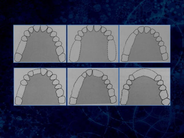 Classification of Partially Edentulous Arches | PPTX