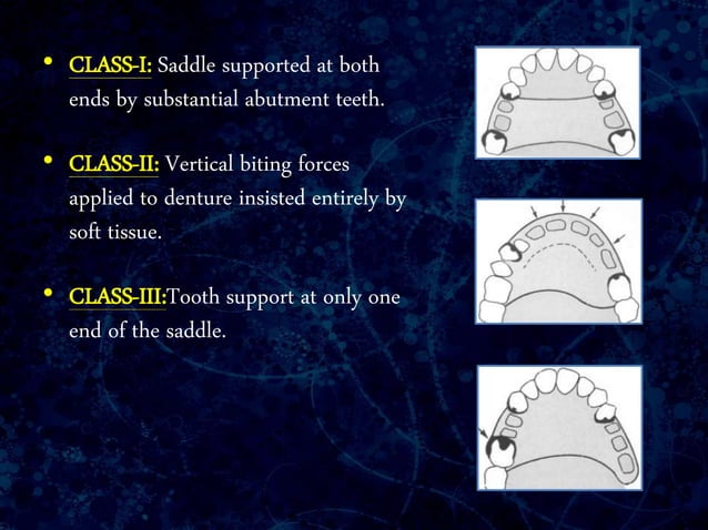 Classification of Partially Edentulous Arches | PPTX