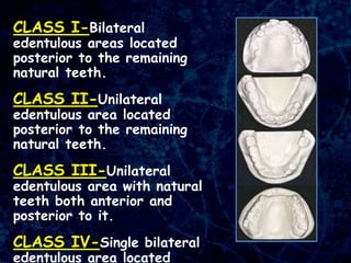 Classification of Partially Edentulous Arches | PPT
