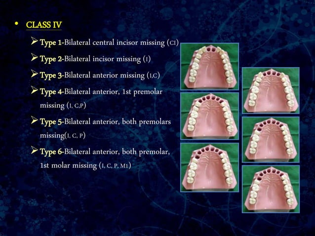 Classification of Partially Edentulous Arches | PPT