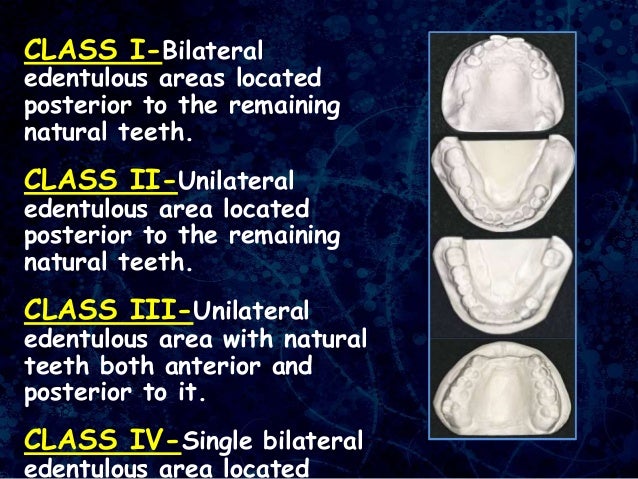 Classification of Partially Edentulous Arches