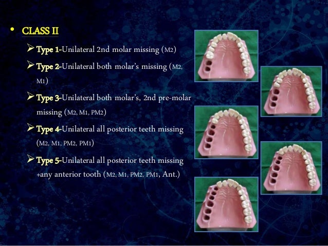 Classification of Partially Edentulous Arches