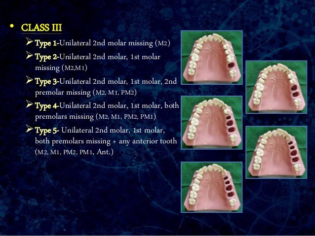 Classification of Partially Edentulous Arches