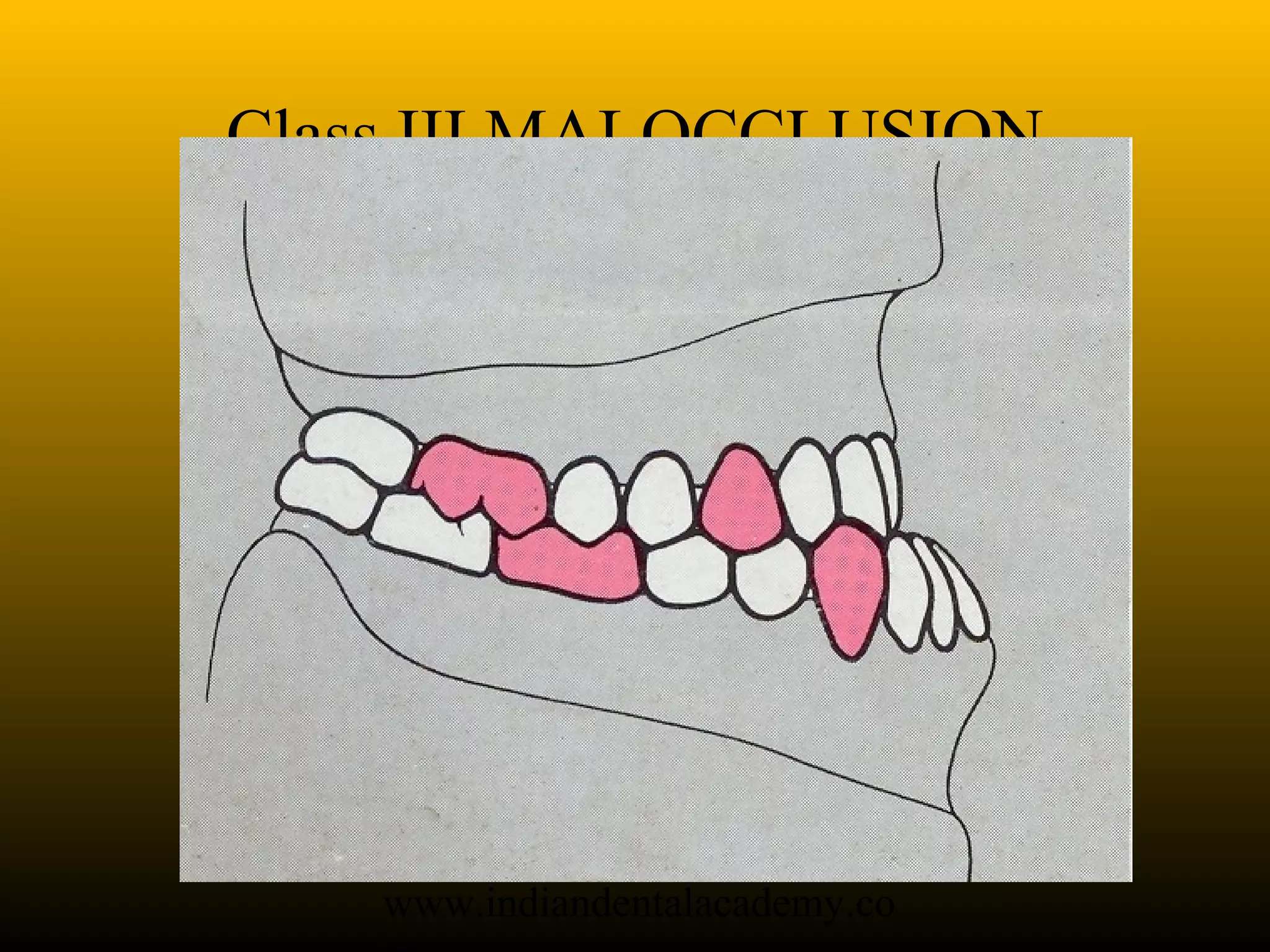 Classification of malocclusion in orthodontics /certified fixed ...