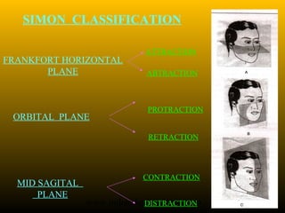 Classification of malocclusion in orthodontics /certified fixed ...
