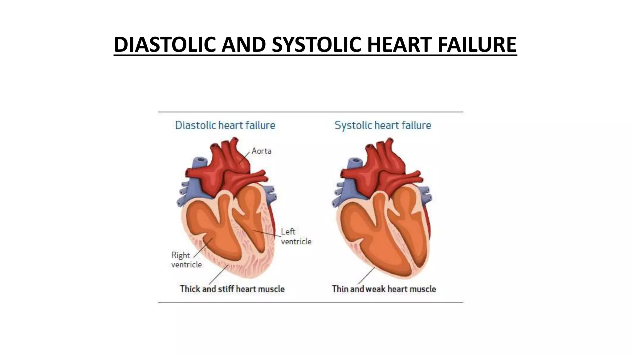Classification and clinical features of congestive heart failure | PPTX