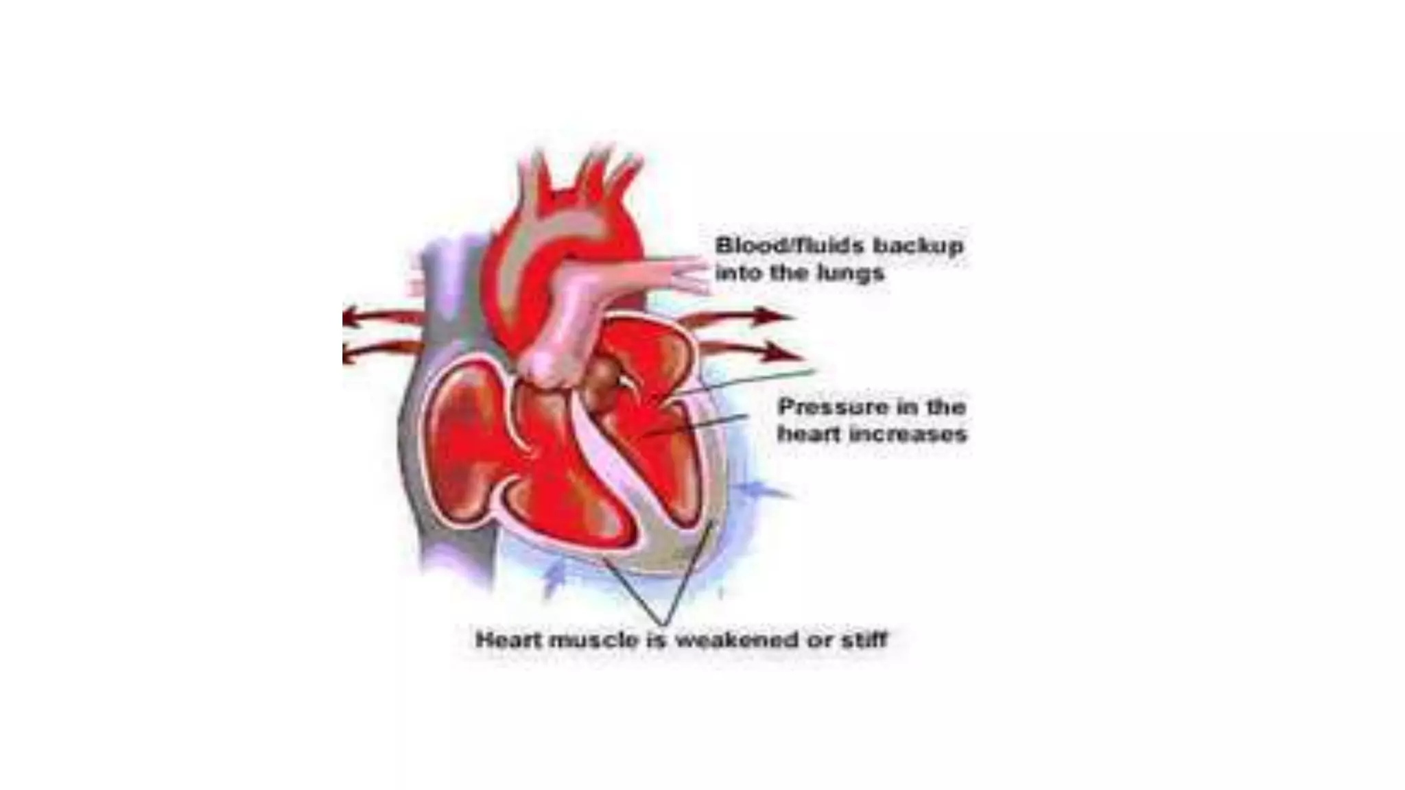 Classification and clinical features of congestive heart failure | PPTX