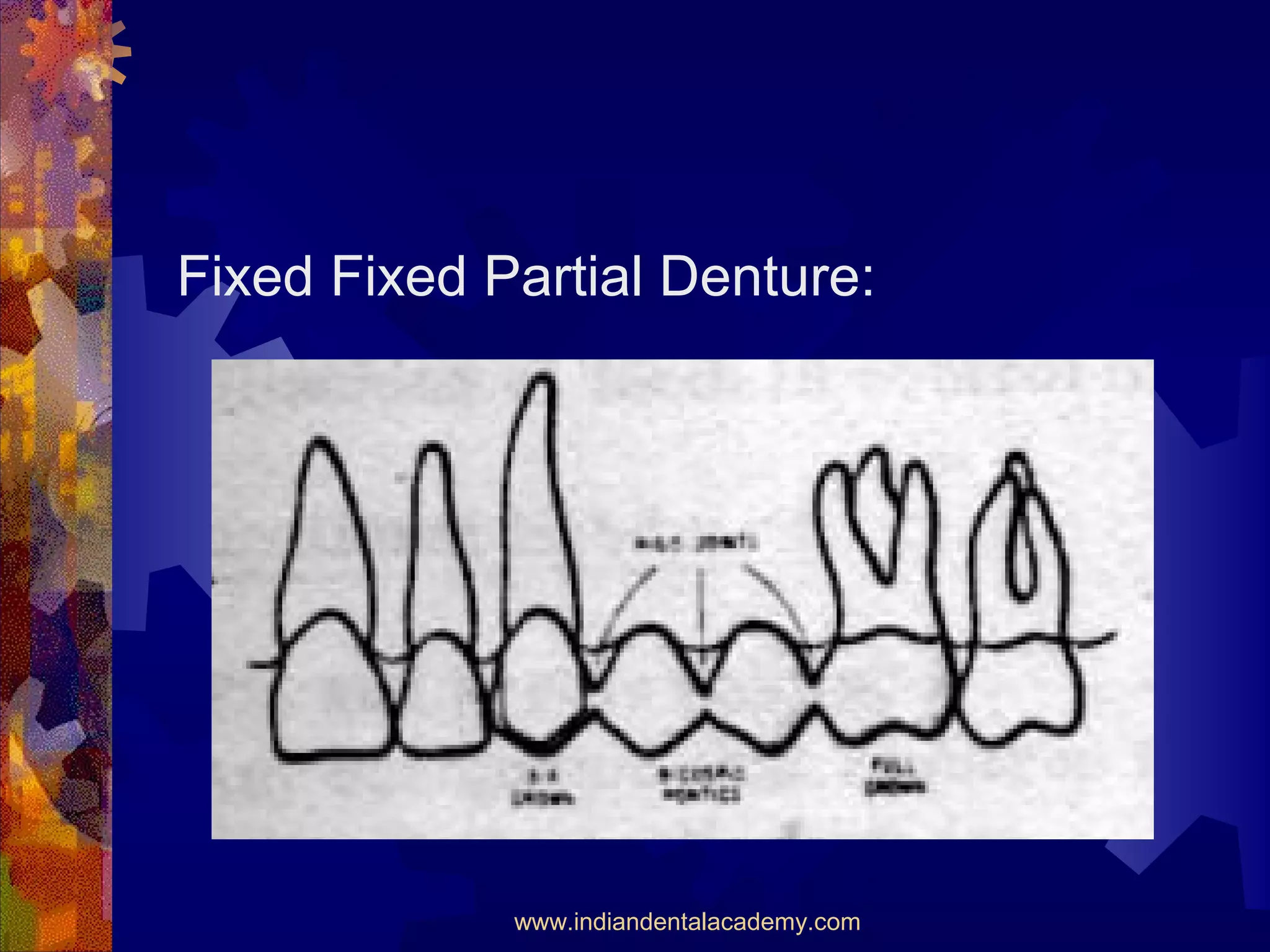 Classification and configuration for fpd/dental courses | PPT