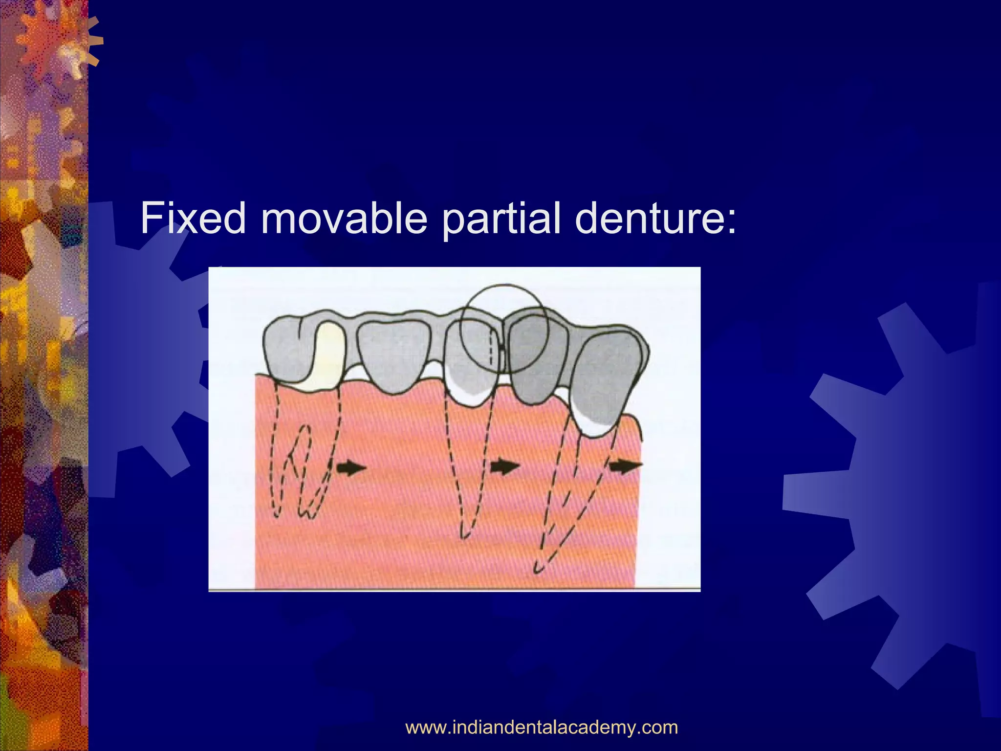 Classification and configuration for fpd/dental courses | PPT