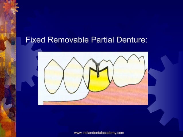 Classification and configuration for fpd/dental courses | PPT