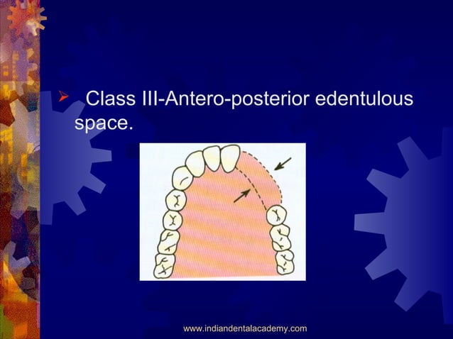 Classification and configuration for fpd/dental courses | PPT