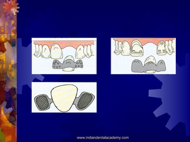 Classification and configuration for fpd/dental courses | PPT