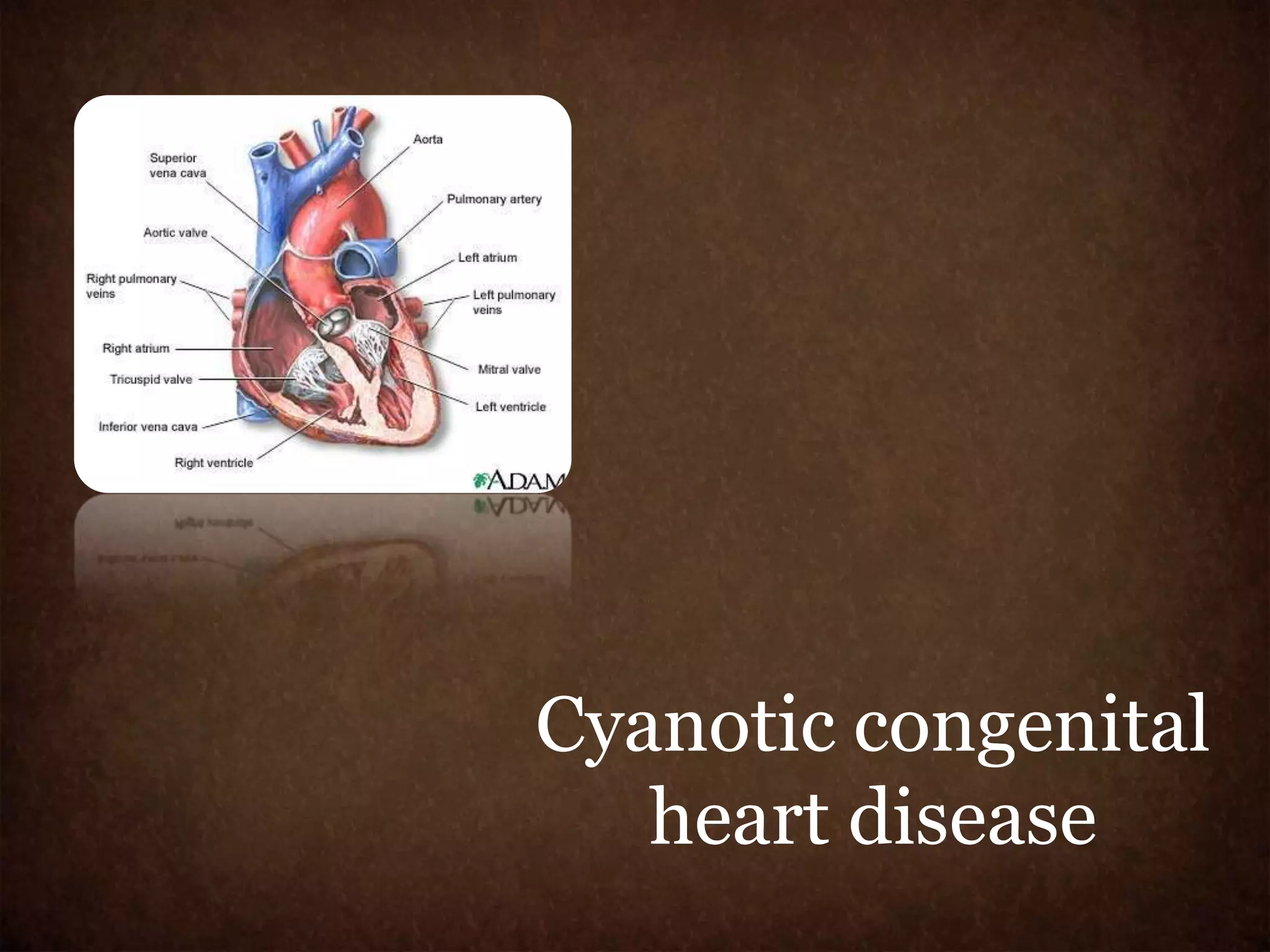 Classification of Congential Heart Diseases and cyanotic heart disease ...