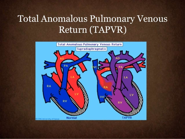 Classification of Congential Heart Diseases and cyanotic heart disease