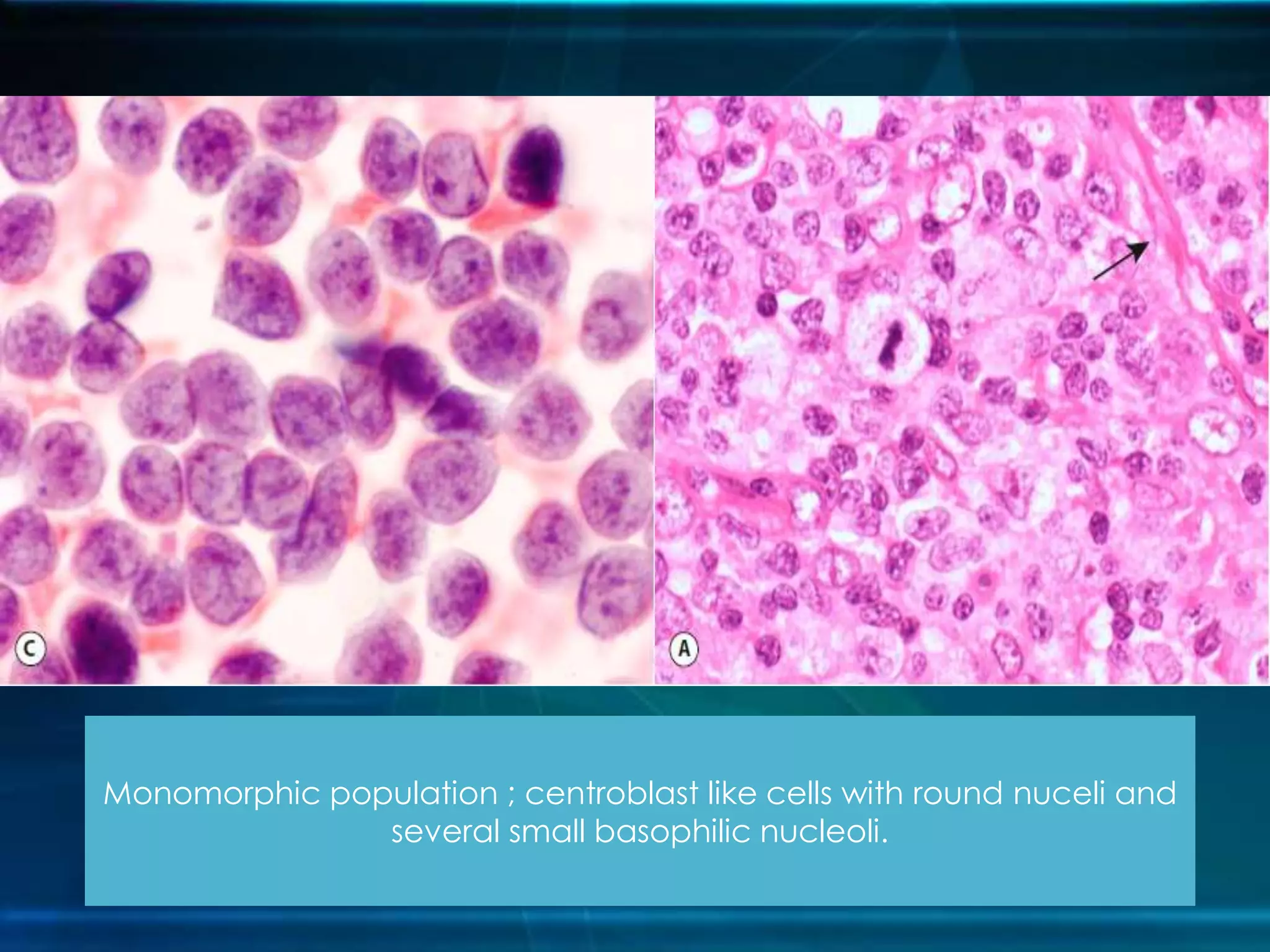 Classification and diagnostic approach to fnac of mediastinal | PPTX