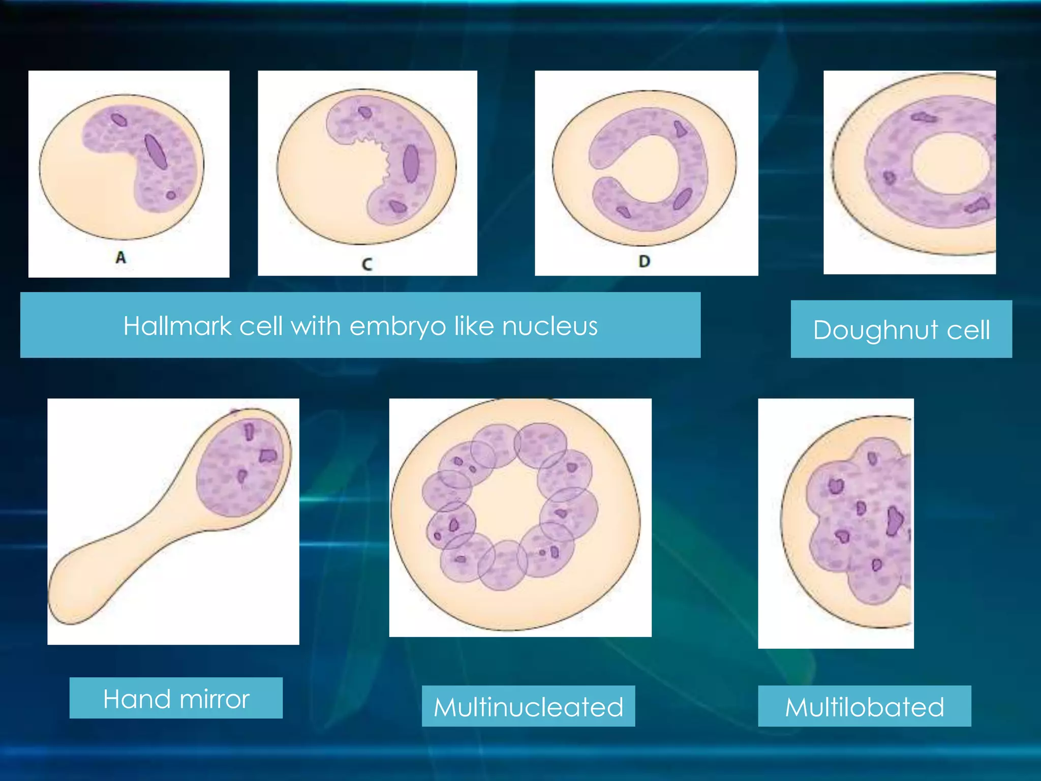 Classification and diagnostic approach to fnac of mediastinal | PPTX