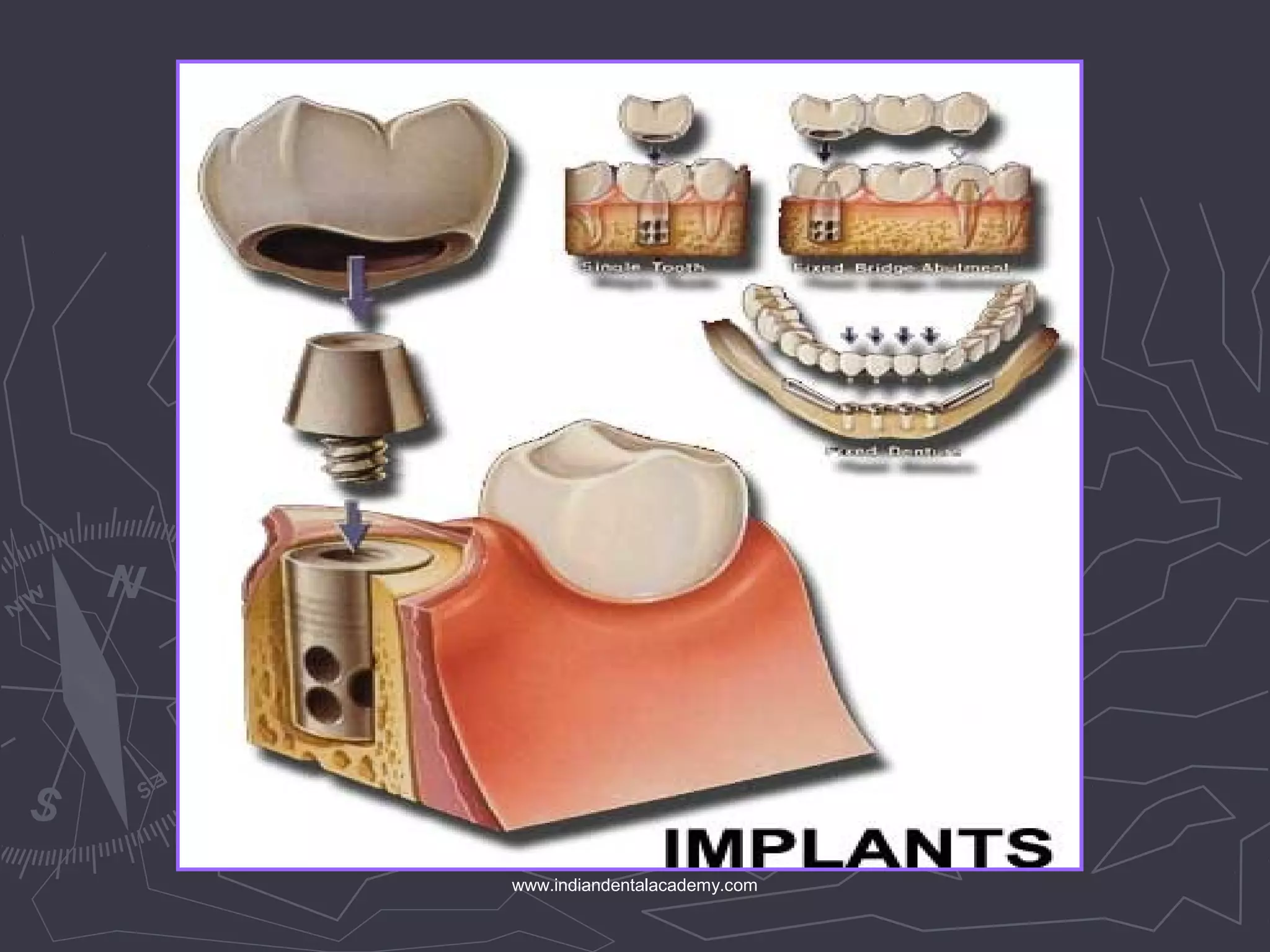 Classification and impression techniques of implants/ dentistry dental ...
