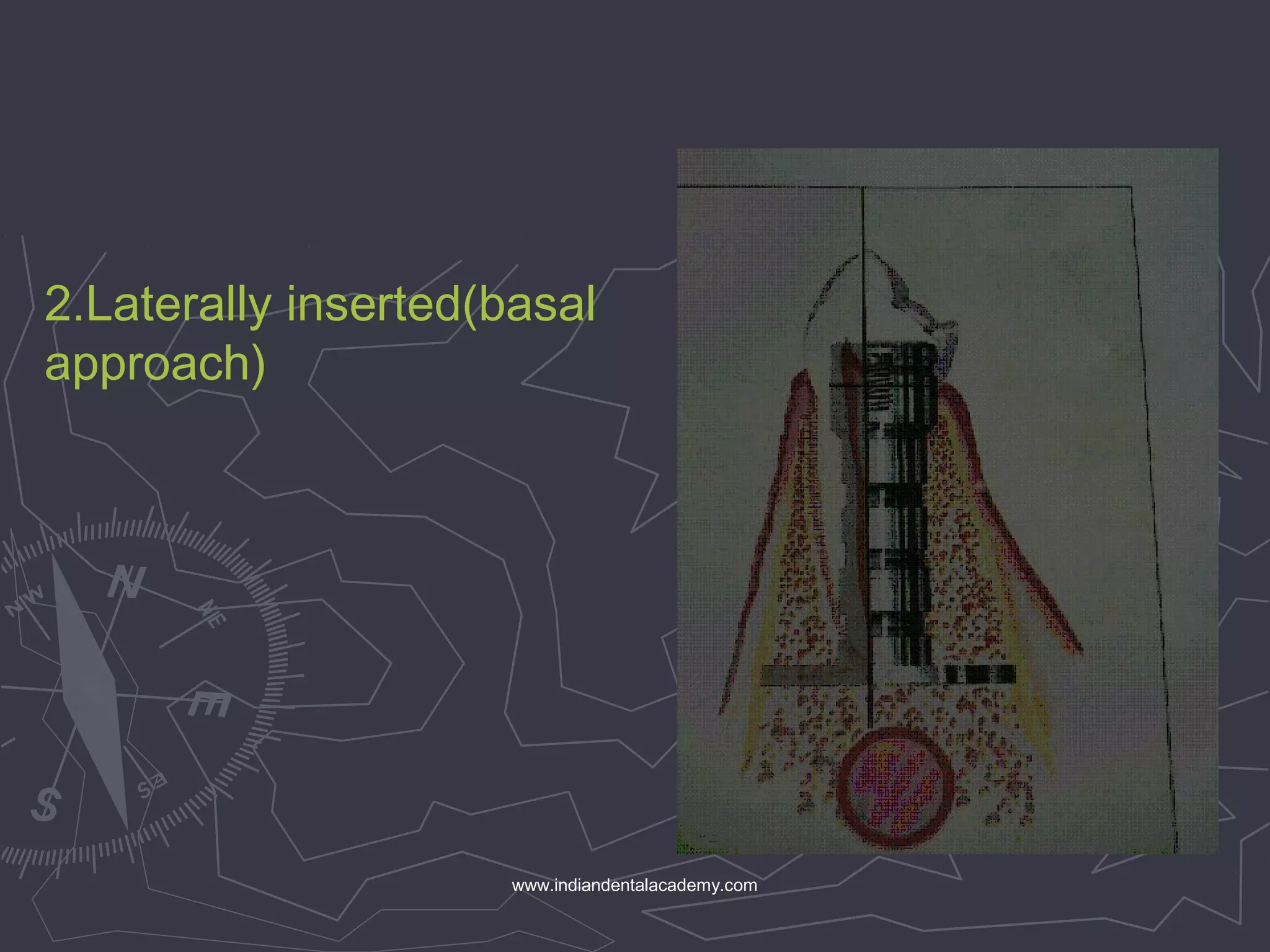 Classification and impression techniques of implants/ dentistry dental ...