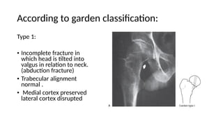 CLASSIFICATION AND MANAGEMENT OF NOF FRACTURE-1.pptx