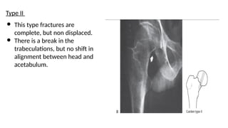 CLASSIFICATION AND MANAGEMENT OF NOF FRACTURE-1.pptx