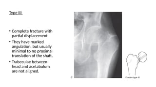 CLASSIFICATION AND MANAGEMENT OF NOF FRACTURE-1.pptx