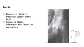 CLASSIFICATION AND MANAGEMENT OF NOF FRACTURE-1.pptx
