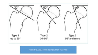 CLASSIFICATION AND MANAGEMENT OF NOF FRACTURE-1.pptx