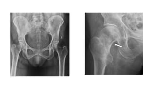 CLASSIFICATION AND MANAGEMENT OF NOF FRACTURE-1.pptx