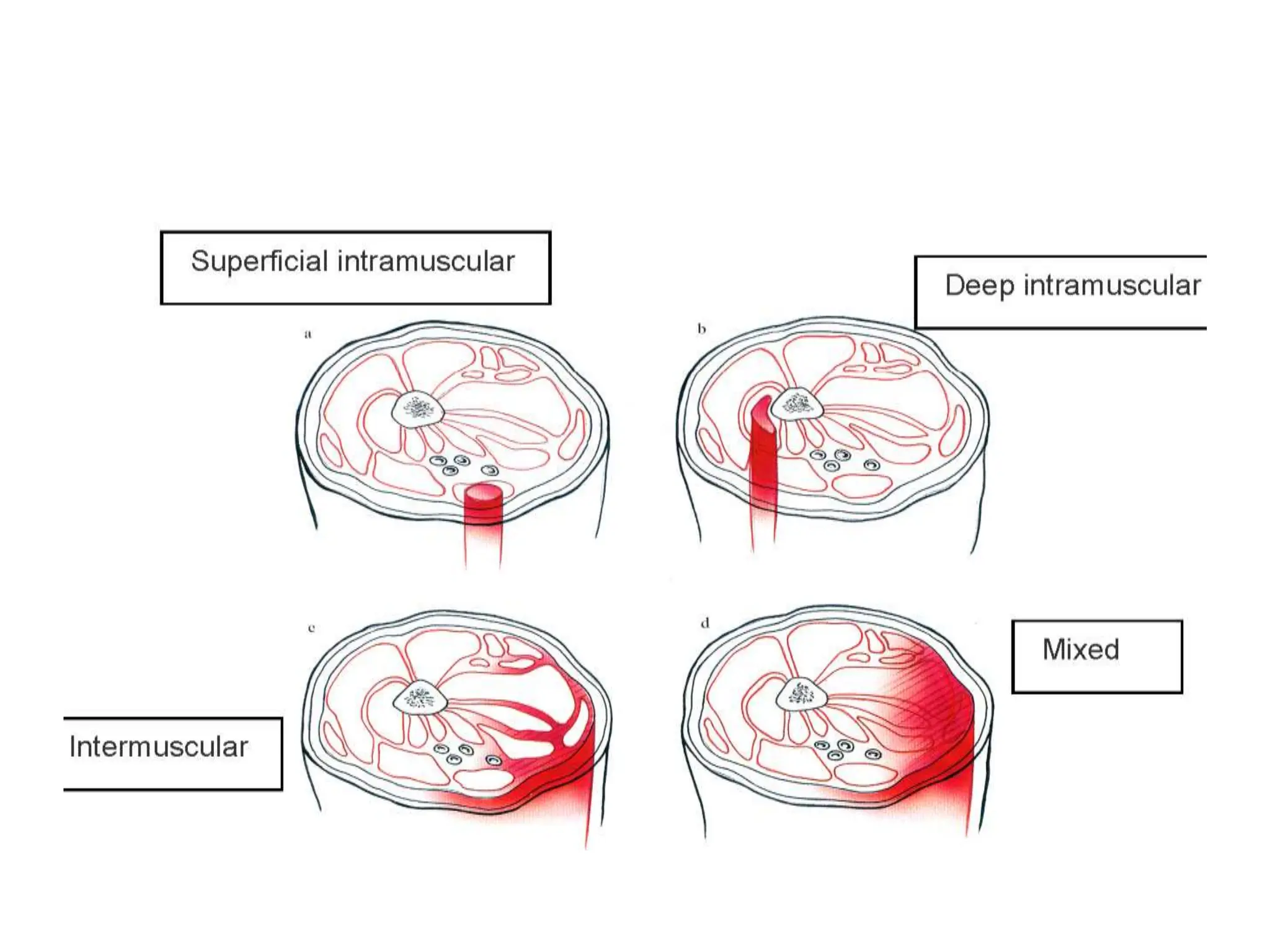 Classification and Management of Sports Injuries.pptx