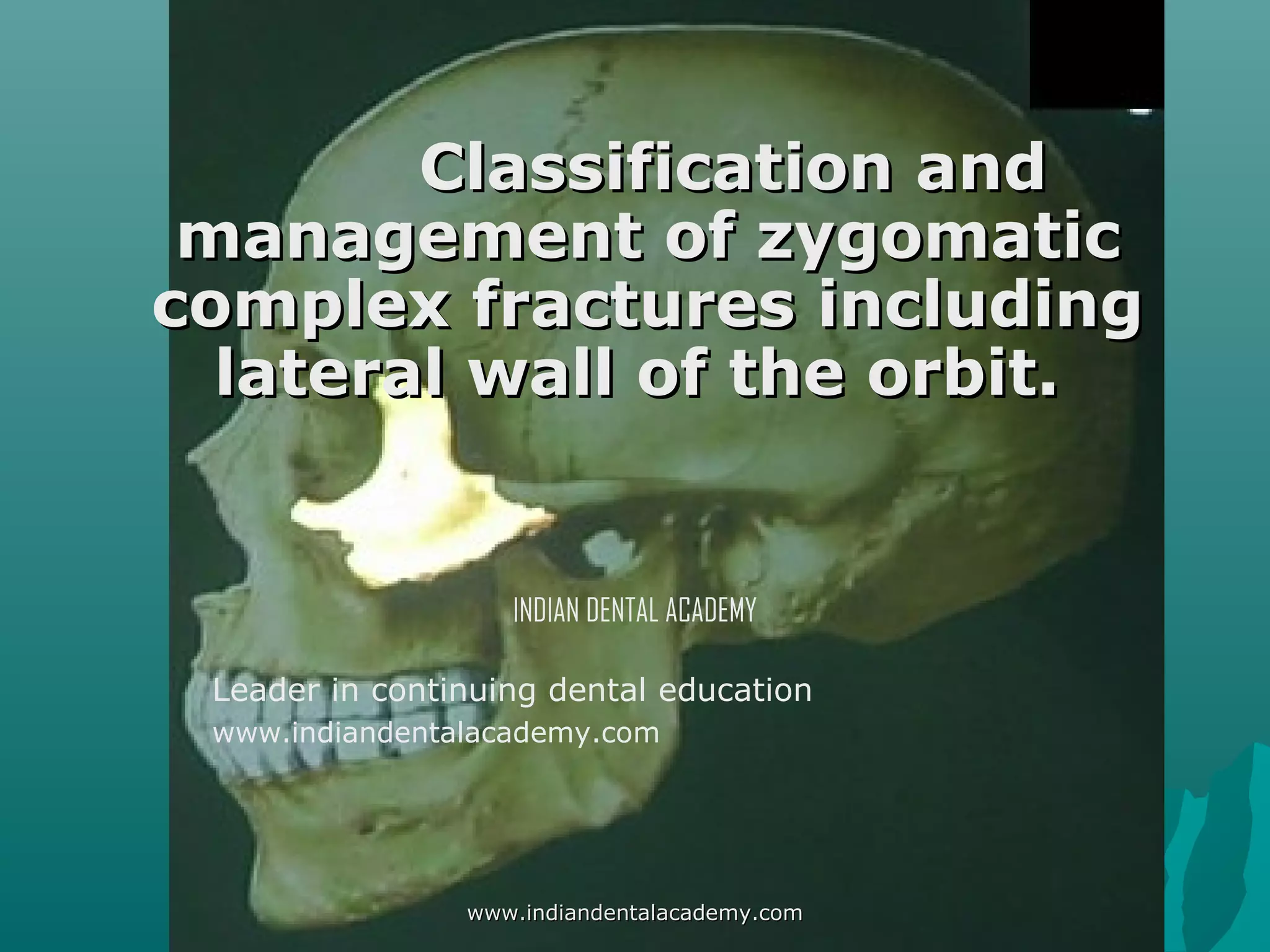 Classification & management of zygomatic complex fractures including ...