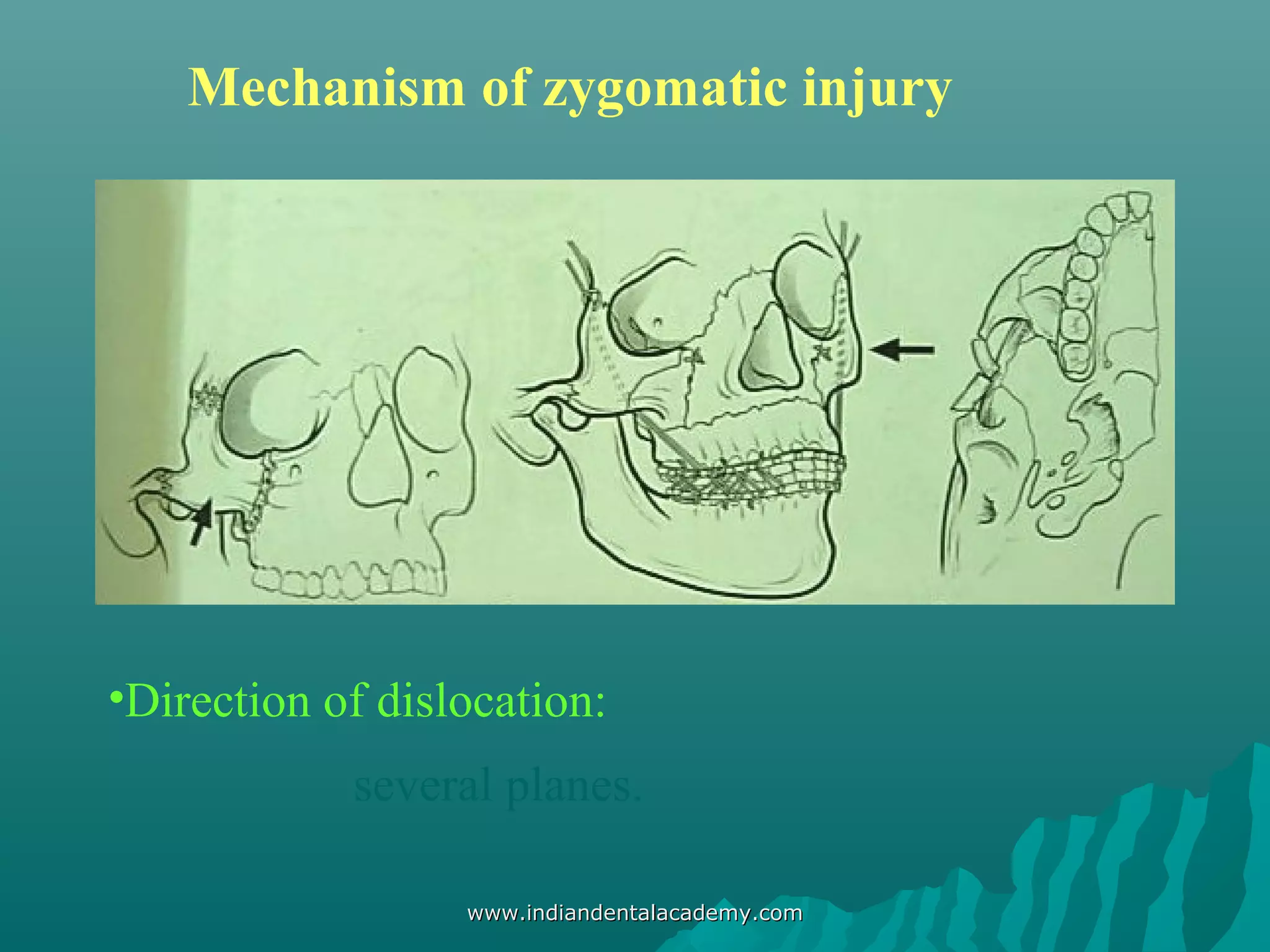 Classification & management of zygomatic complex fractures including ...