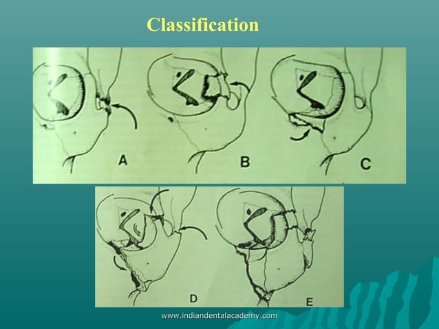 Classification & management of zygomatic complex fractures including ...