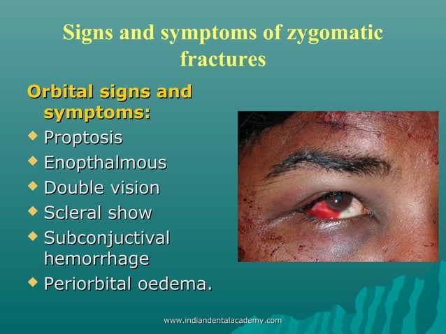 Classification & management of zygomatic complex fractures including ...