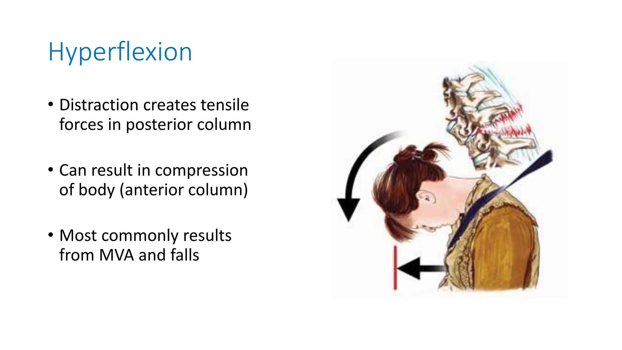 Classification and mechanism of subaxial cervical spine injuries.pptx