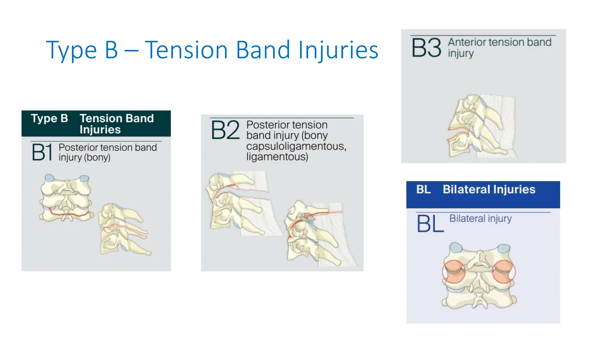 Classification and mechanism of subaxial cervical spine injuries.pptx