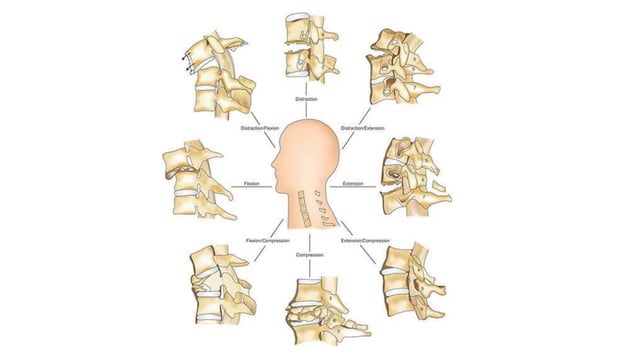 Classification and mechanism of subaxial cervical spine injuries.pptx