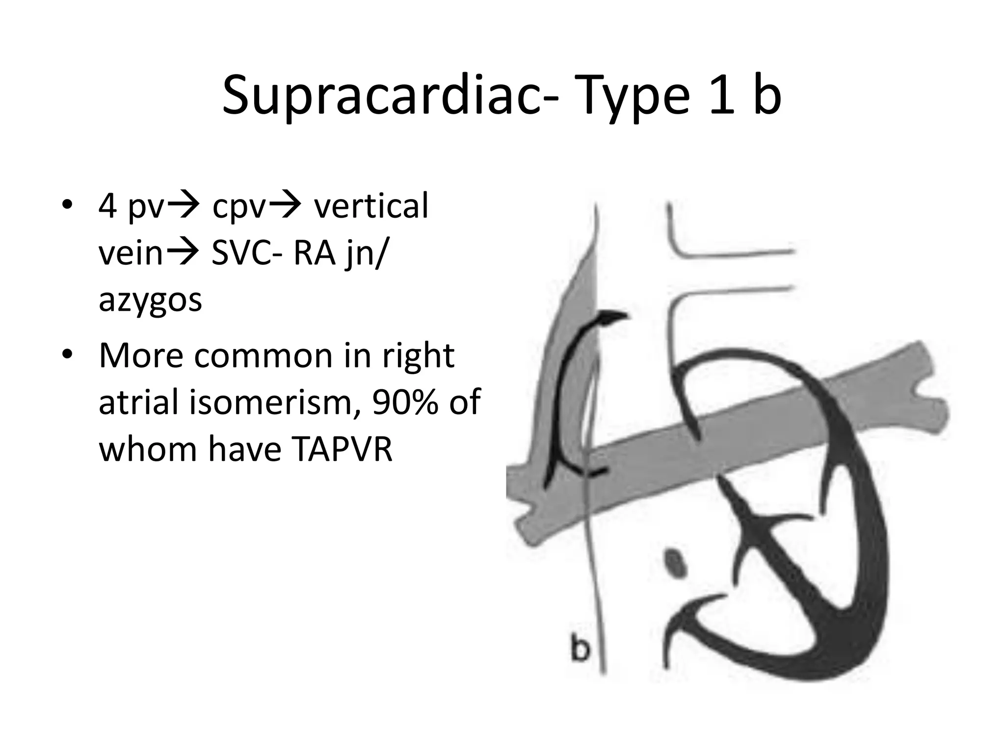 Classification and pathophysiology of tapvc | PPTX
