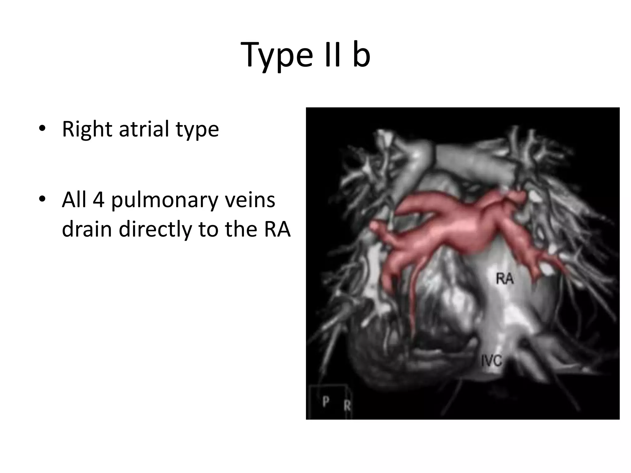 Classification and pathophysiology of tapvc | PPTX