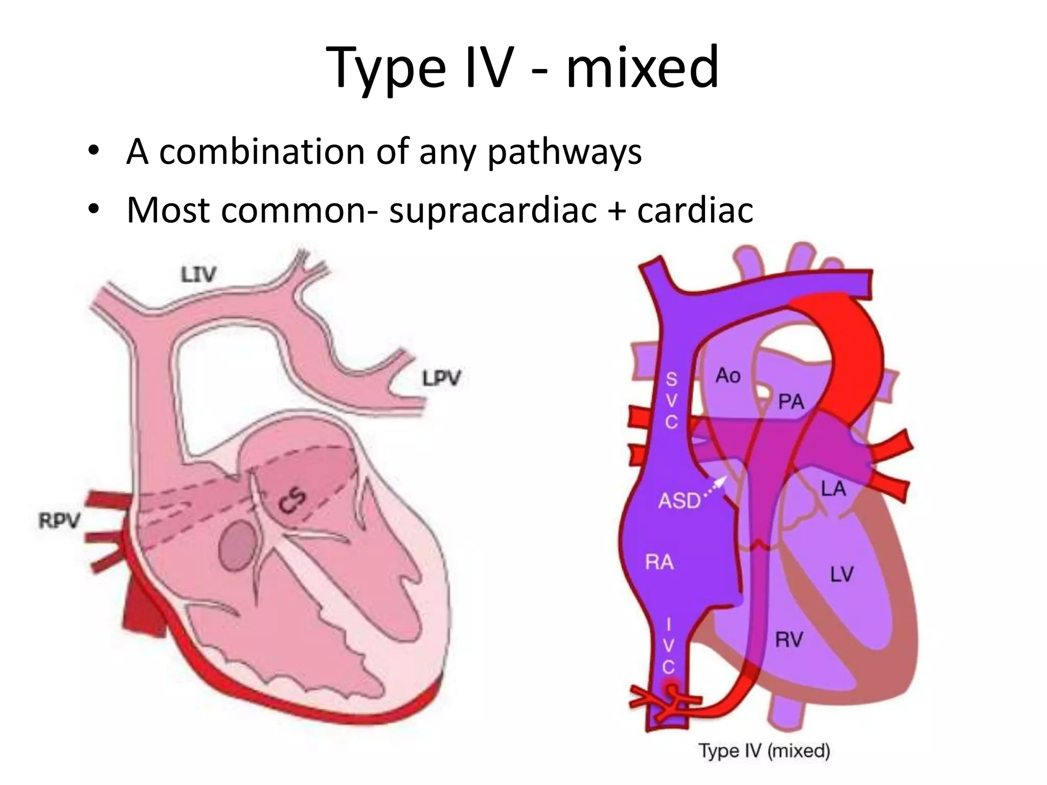 Classification and pathophysiology of tapvc | PPTX